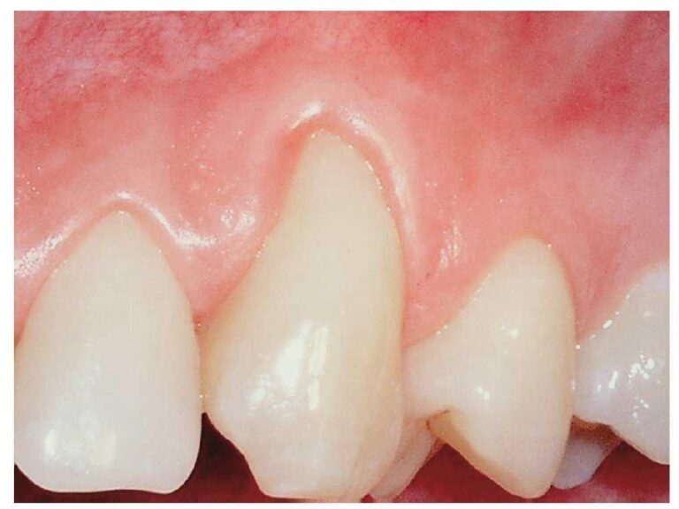 ¿Por qué se retraen las encías? - ZherMedical